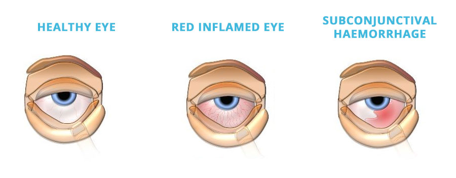 EYE-INFECTION - Naqshbandi Sufi New York